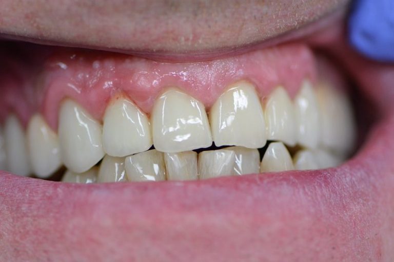 Cirkon keramika | Ordinacija dentalne medicine dr. Milorad Čeko